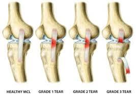 Comprehensive Guide to Managing an MCL/LCL Sprain: Diagnosis, Treatment ...